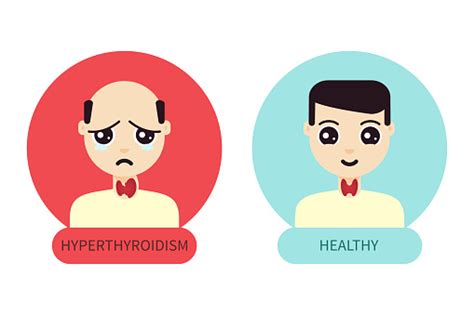 일반 및 Hyperthyroid 선 남자 갑상샘에 대한 스톡 벡터 아트 및 기타 이미지 갑상샘 갑상샘기능 항진증 갑상샘암