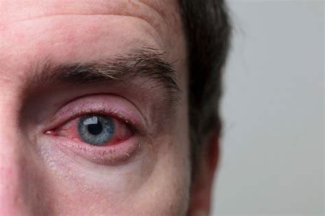 Conjunctivitis Types And Treatment Ophthalmology Clinic Drhc Dubai