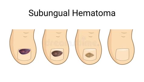 Stages Of Toe Hematoma Healing Process Stock Vector Illustration Of