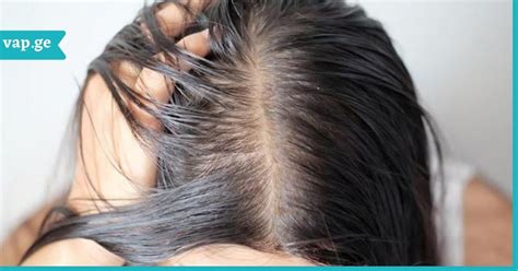 ეფექტული ხალხური რეცეფტები ცხიმიანი თმისთვის Vap Ge