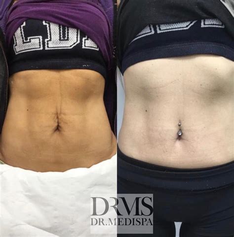 Morpheus Skin Tightening At Dr Medispa In London Loughton Essex