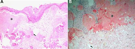 Figure 2 From Gelatinous Drop Like Corneal Dystrophy With A Novel Mutation Of Tacstd2 Manifested