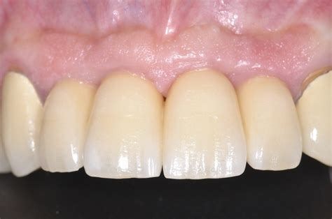 Ridge Preservation With Maxgraft® Mucoderm® And Jason® Membrane Dr F