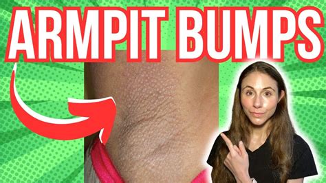 Understanding Fox Fordyce Disease Your Guide To Armpit Bumps Youtube