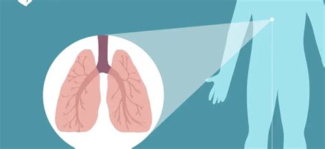 Bronchitis Symptoms Types Treatment Complications Explained