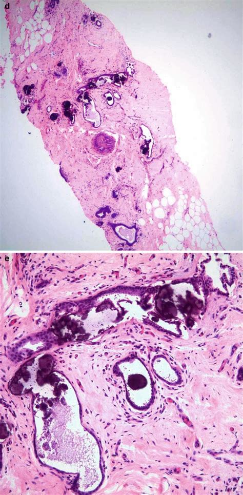 Radiology Of Benign Breast Lesions Radiology Key