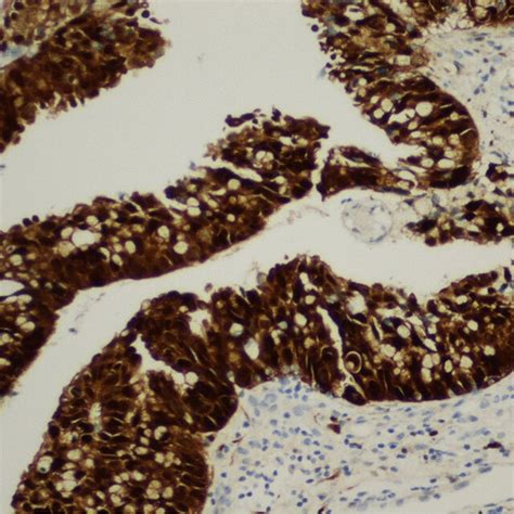 P16 Immunohistochemistry × 40 Magnification Diffuse Strongly Positive