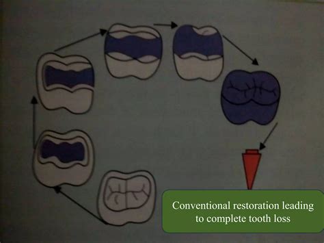 Preventive Resin Restoration PPTX Preventive Resin Restoration PPTX