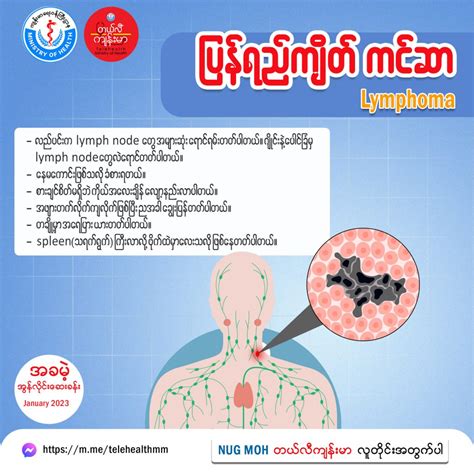 သွေးအကျိတ်ကင်ဆာ ခေါ် ပြန်ရည်ကျိတ်ကင်ဆာ Lymphoma တယ်လီကျန်းမာ