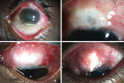 Blebitis And Bleb Related Endophthalmitis Ento Key