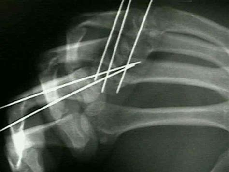 Hand And Metacarpal Fractures Wheeless Textbook Of Orthopaedics