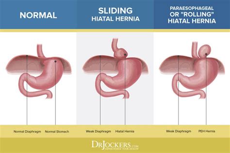 Inguinal Hernia Doctor Clinic Surgery Mumbai