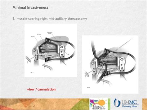 Right Axillary Thoracotomy Chd Repair Usa Grand Rounds