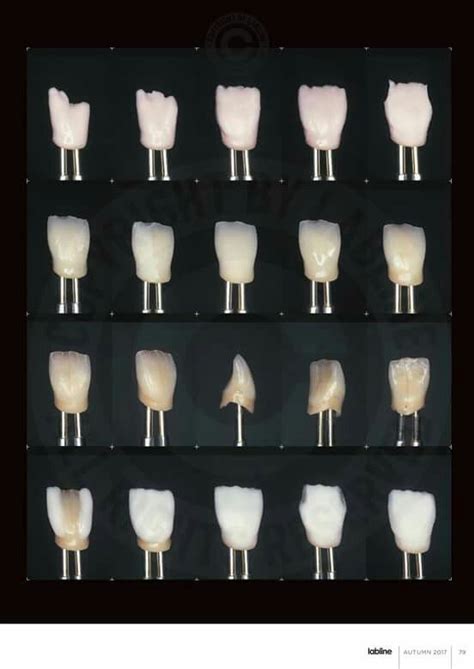 Pin De Carlos Cotrino En Moldes Dentales Laboratorio Dental Dental