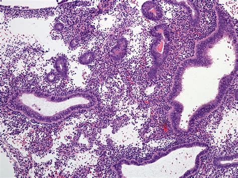Pathology Outlines Disordered Proliferative