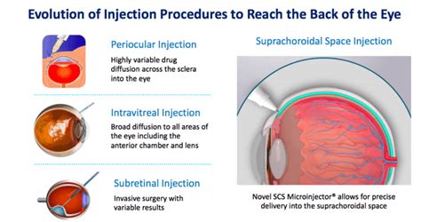Clearside Biomedical Scs Microinjector Platform With Significant