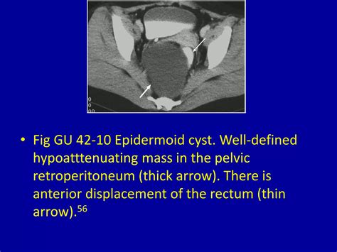 42 Cystic Retroperitoneal Mass Ppt