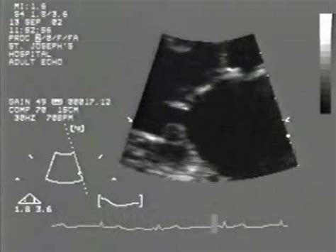 Mitral Stenosis Mitral Stenosis MSD Manual Professional Edition