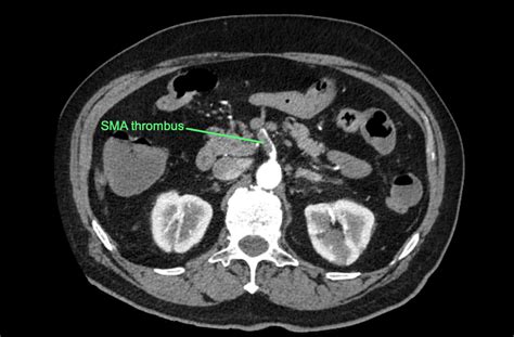 CT Case LITFL CT Scan Interpretation