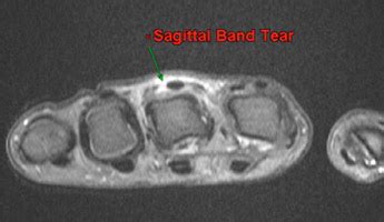 Sagittal Band Rupture Splint