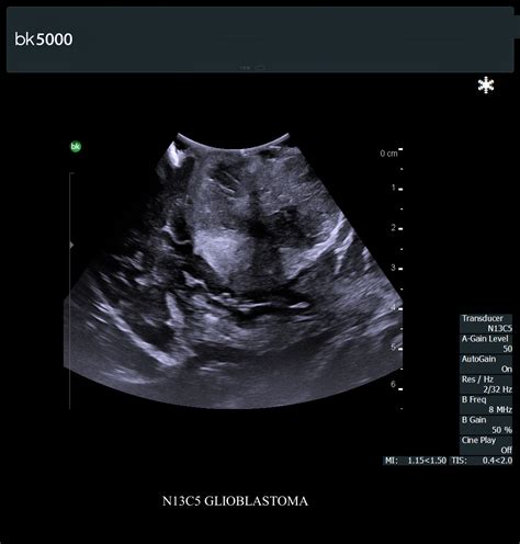 Guiding Tumor Resections In Neurosurgery With Intraoperative Ultrasound Prof Geirmund Unsgård