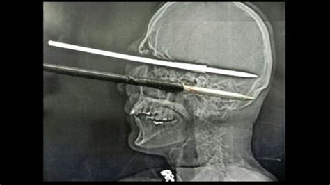 Man Shoots Himself In Head With Harpoon Gun World News Sky News