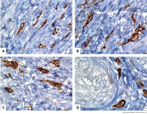 Telocytes In Cutaneous Biology A Reappraisal Actas Dermo Sifiliográficas