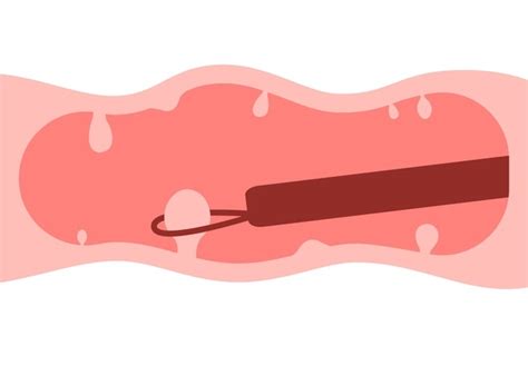 373 Colon Polyps Colon Cancer Stock Vectors And Vector Art Shutterstock