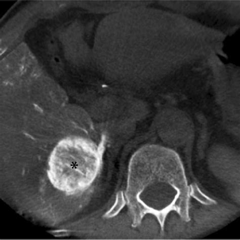 Post Tace Right Hepatic Angiogram Showing Residual Tumor Blush White Download Scientific