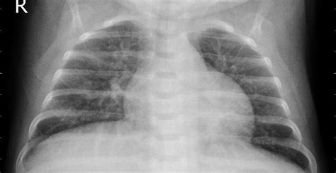 Azraahmadi Autotrain Data Xray Dataset · Datasets At Hugging Face