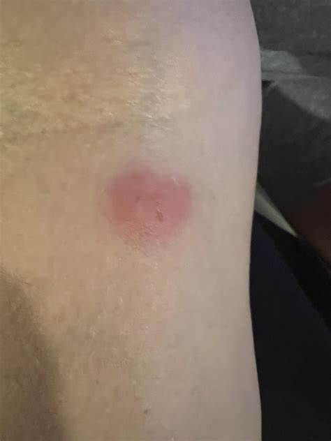 Scorpion Spider Bite