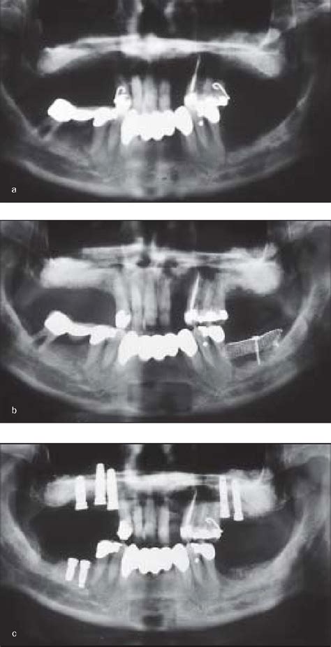 Figure 2 From Vertical Alveolar Ridge Augmentation Prior To Inferior
