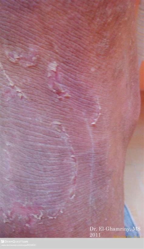 Ichthyosis