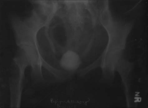 Lupus Cystitis An Unusual Presentation Of Systemic Lupus Erythematosus Indian Journal Of