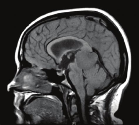 Normal Anatomy Sagittal Fiestac Mri Image A And Axial