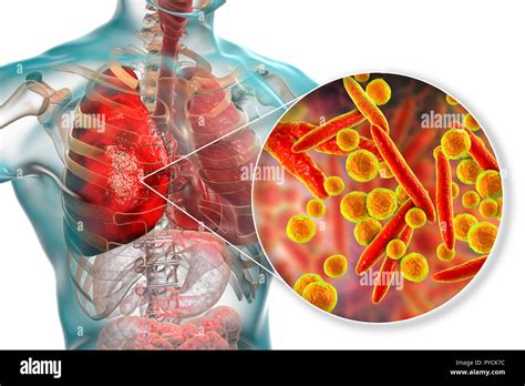 Mycoplasma Pneumonia