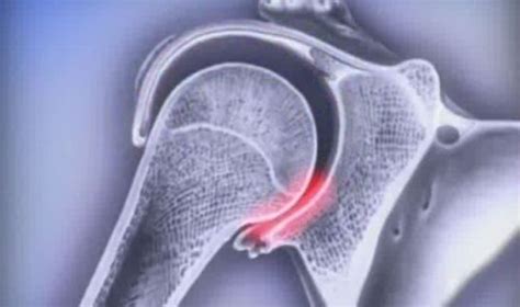 The Types And Indications For Use Drugs Chondoprotective Medical