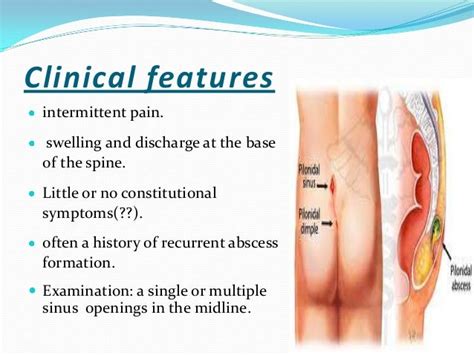 Surgical Treatment Of Pilonidal Disease