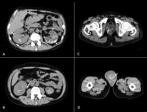 Extensive Urogenital Calcification And Hypercalcemia Secondary To Disseminated Tuberculosis
