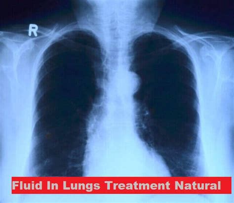 How Serious Is Water Around The Lungs At Cynthia Hewlett Blog