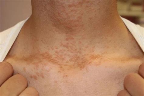 Nguyên Nhân Mụn Li Ti ở Cổ Và 5 Cách Xử Lý Tại Nhà Hiệu Quả Actidem