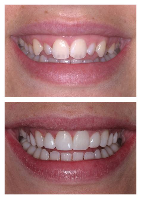 Cosmetic Bonding Dentist Burgess Hill Denplan Dentist West Sussex