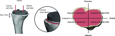 Three Dimensional Models Of Proximal Tibia And Tibial Components