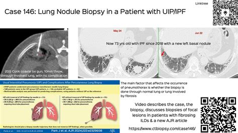 Case 146 Lung Nodule Biopsy In A Patient With Uip Ipf