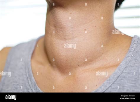 Enlarged Thyroid