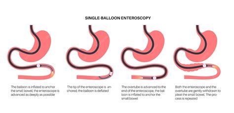 Premium Vector Single Balloon Enteroscopy Procedure Visualization Of