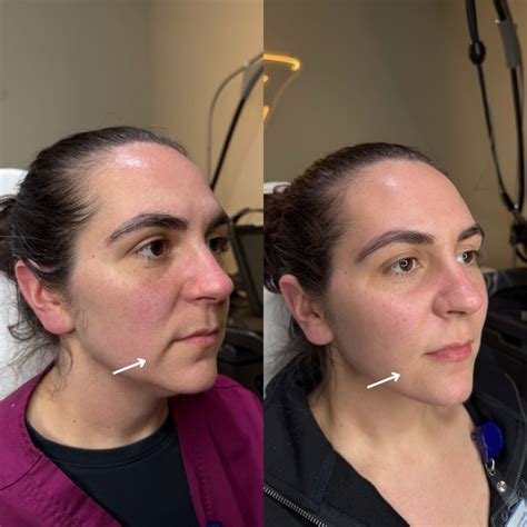 Marionette Line Filler Muse Medical Aesthetics