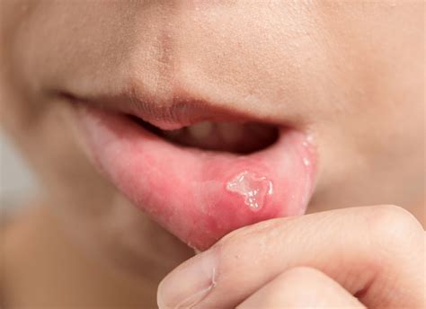 Inflamed Circumvallate Papillae