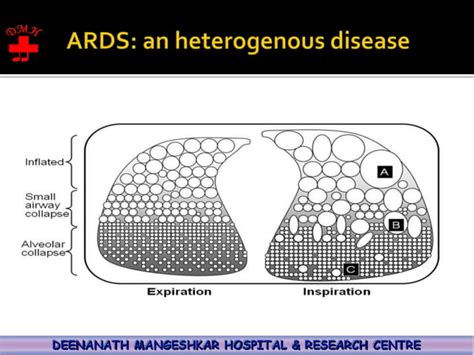 Ards Patho Physiology 1pptx