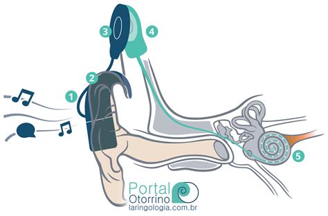 Partes De Um Diagrama De Implante Coclear Desarrollo De Un Sistema
